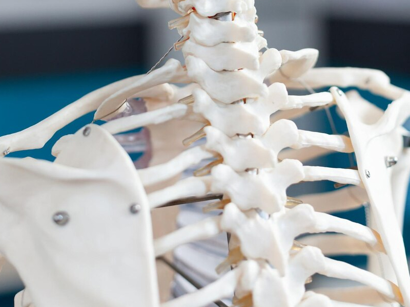 Vidalı Omurga Dondurma-Kaynatma-Sabitleme Ameliyatı (Spinal Füzyon ...